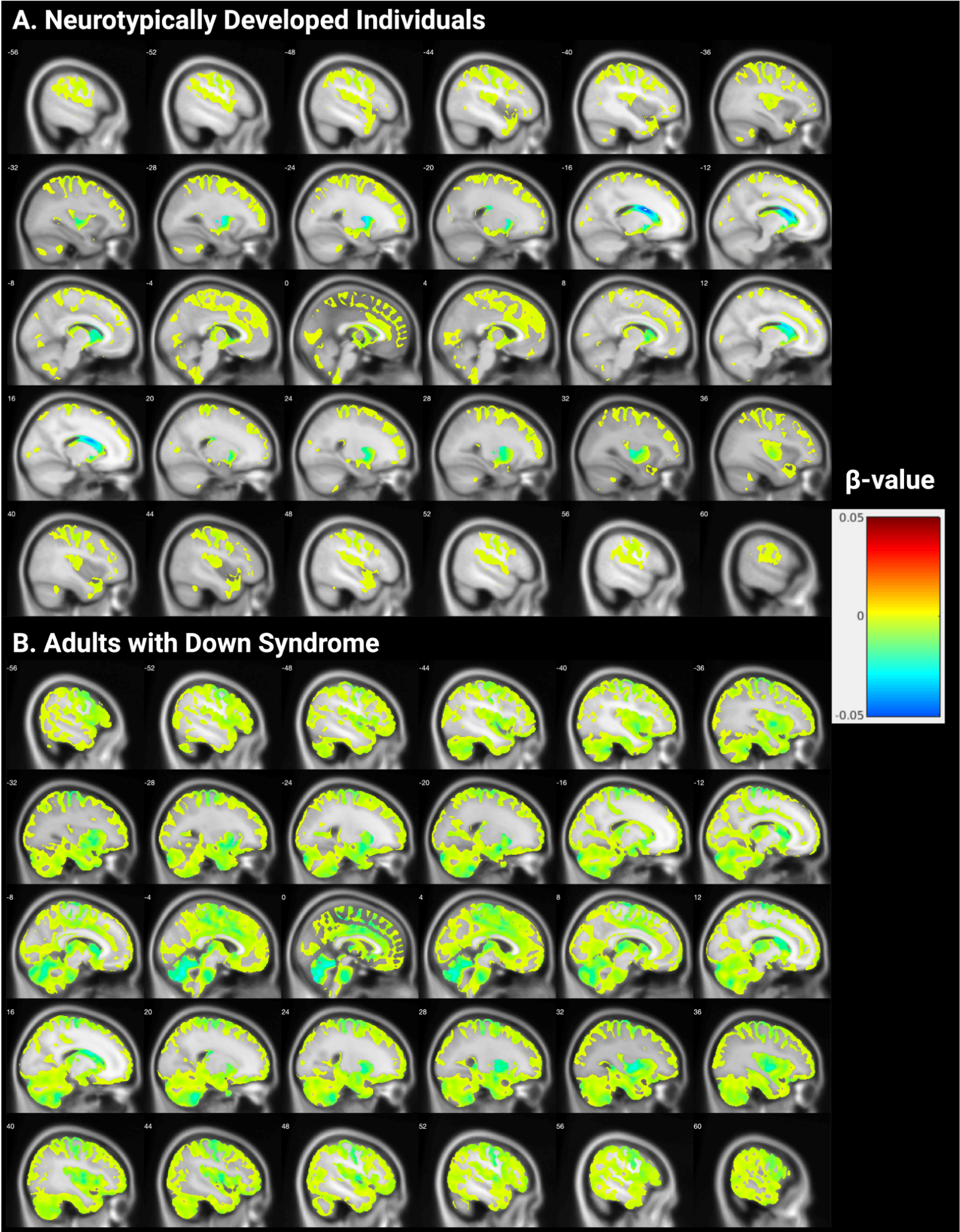 Brain study offers insight into Alzheimer's risk in people with Down ...